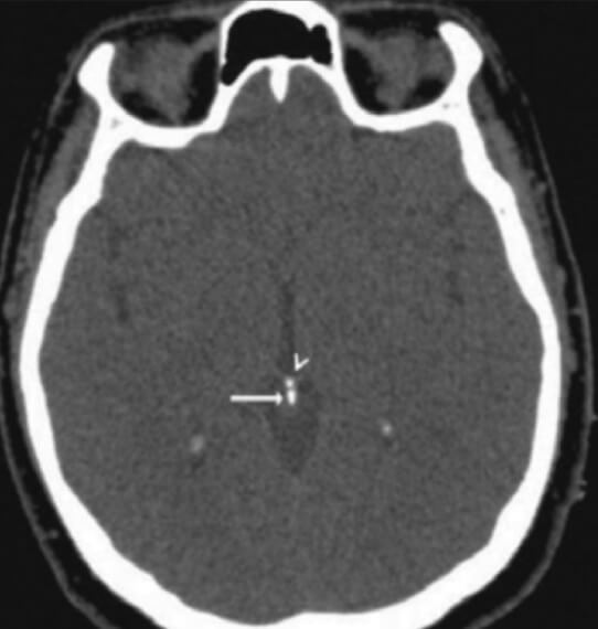 Epifiz Bezi ve Özellikleri