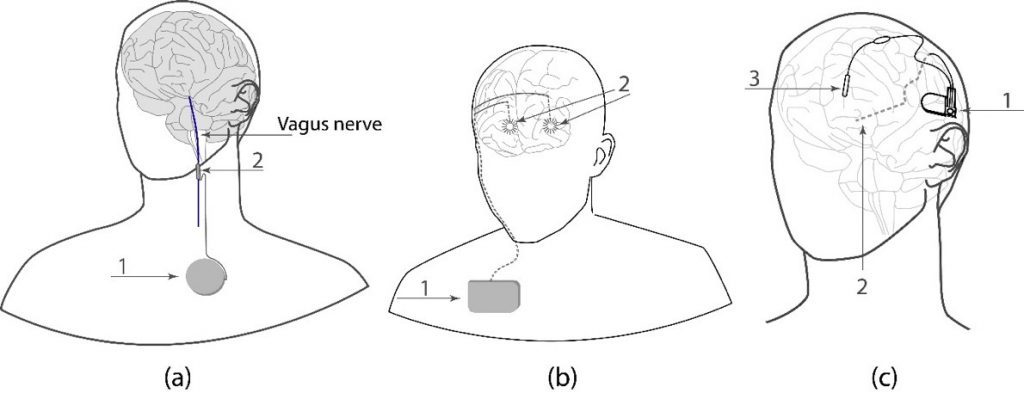 Neuropace | Bilim Ve Tekno